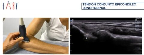 Tendinopatía lateral de codo - Easy Fisioterapia