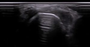 Ecografía del codo lateral. Tendón conjunto epicondíleo - Easy Fisioterapia