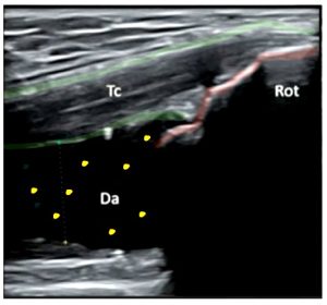 Ecografía en la artrosis de rodilla - Easy Fisioterapia