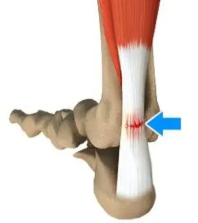 Tratamiento conservador en rotura del tendón de Aquiles - Easy Fisioterapia