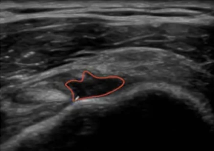 La rotura parcial del tendón supraespinoso. Ecografía - Easy Fisioterapia