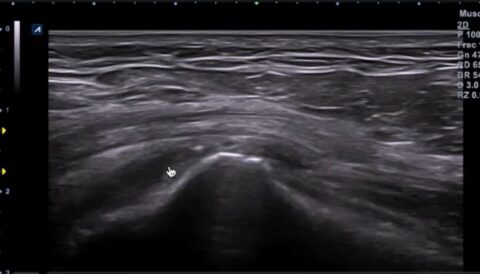 Ecografía de cadera en bursitis trocantérea - Easy Fisioterapia ...
