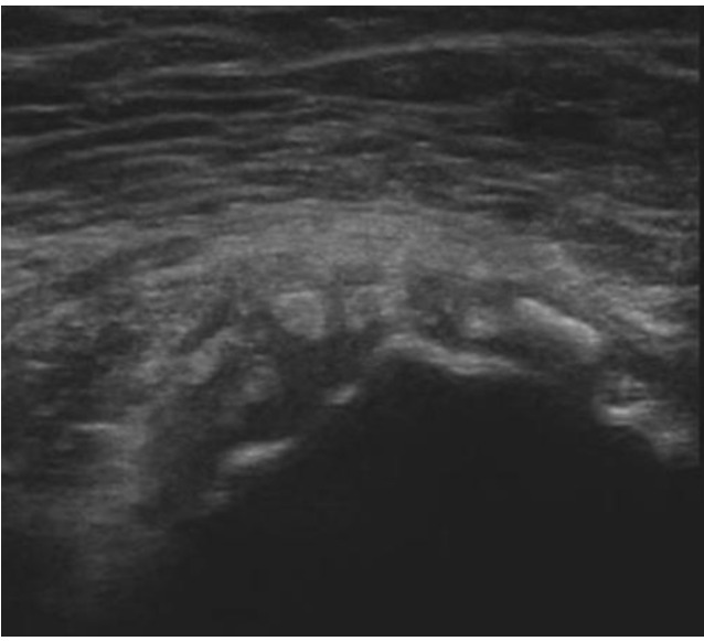 Ecografía de cadera en bursitis trocantérea - Easy Fisioterapia ...