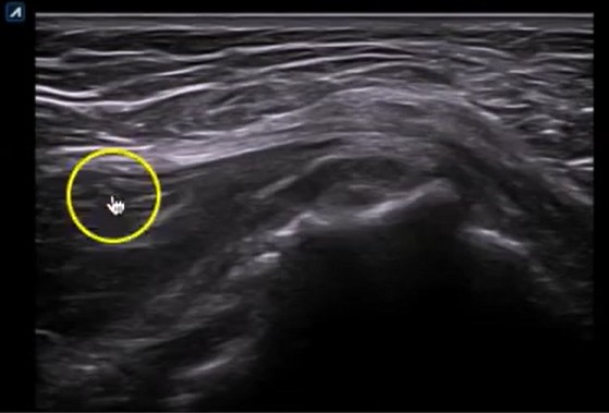Ecografía de cadera en bursitis trocantérea - Easy Fisioterapia ...