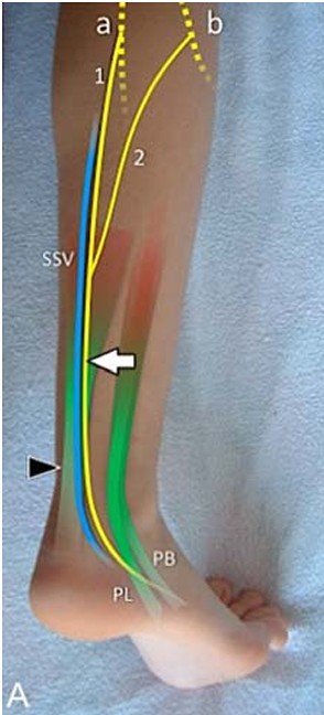 Neuropatías de miembro inferior: exploración ecográfica - Easy ...