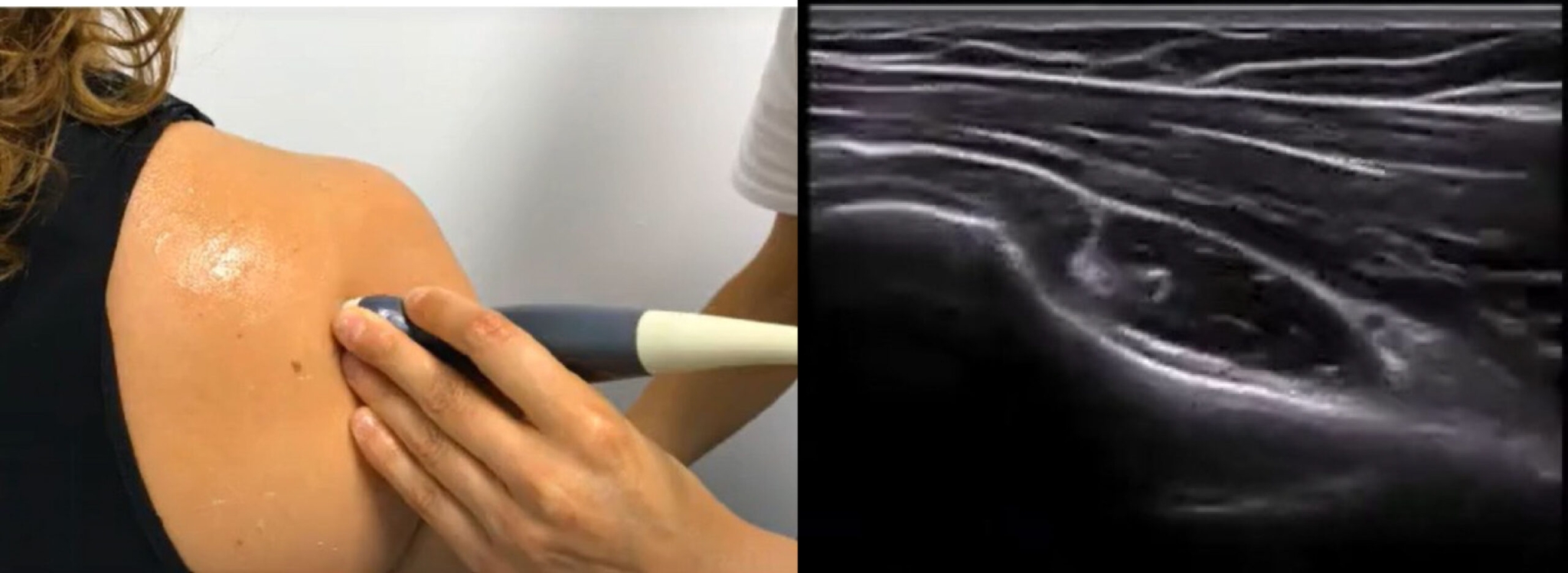 Ecografía de hombro: manguito rotador y bursitis | Easy Fisioterapia