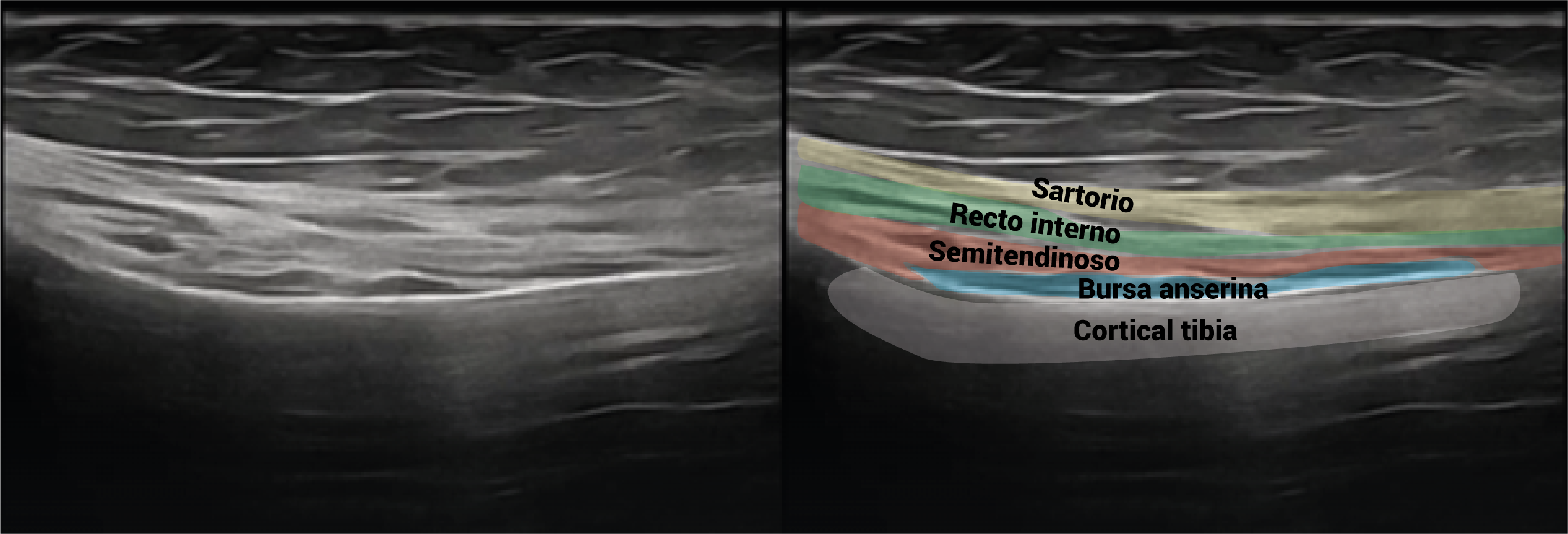 Ecografía en bursitis anserina: cómo evaluar bursitis de la pata de ganso
